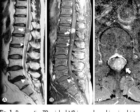 Figure 1 From Intradural Extramedullary Metastasis Of Small Cell Lung Cancer A Case Report