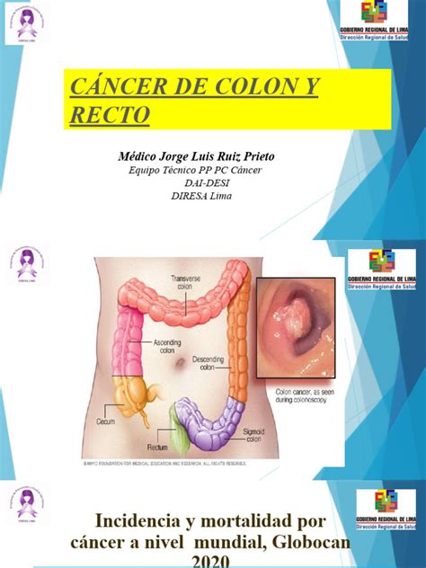 Cancer de Colon Recto 2023 | PDF | Obesidad | Cáncer