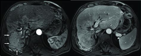 Diffusion Mr Showed Mild Diffusion Restriction In The Posterior Segment Download Scientific