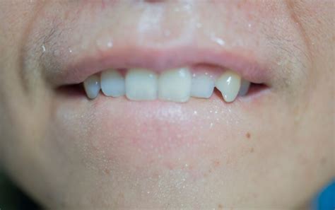 Why Are Some People S Teeth So Pointy Dental Treatments