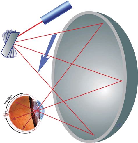 Schematic Illustration Of Ultra Widefield Imaging Of Retina Using An