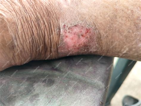 Premium Photo Diabetic Scabbed Feet Scabies Feet Dry Because Of Not