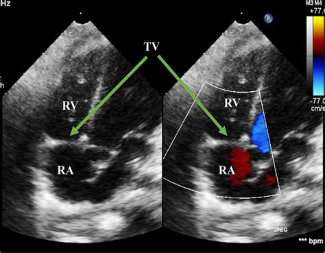Echo At The Latest Visit In The A4c View The Figure Showed Normal