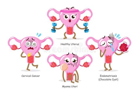 Disease Of Female Reproductive System Include Cervical Cancer Myoma Uteri Endometriosis Or