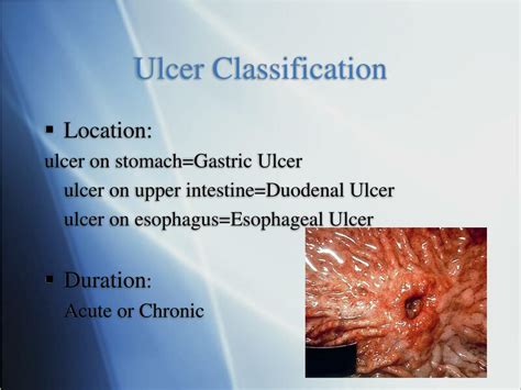 Ppt Nur 120 Peptic Ulcer Disease Powerpoint Presentation Free