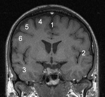 The Anatomy Of The Brains Lobes With Mri Eurorad