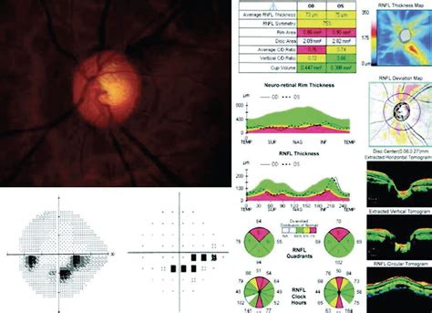 Glaucoma Today On Linkedin Normal Tension Glaucoma Pathogenesis