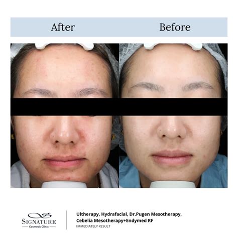 Mesotherapy Toronto Skin Rejuvenation Meso Treatment Signature