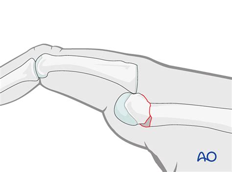 Dislocation And Fracture Dislocation Of The Metacarpophalangeal Joint