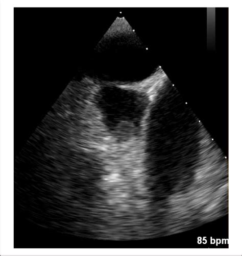 Transesophageal Echocardiogram Showing A Mildly Dilated Left Atrium Download Scientific Diagram