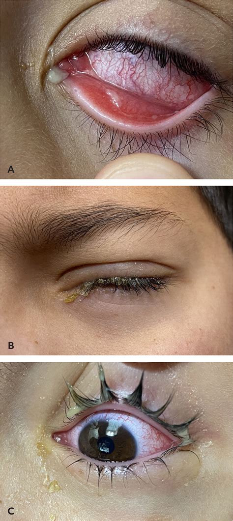 Viral Conjunctivitis Vs Bacterial Conjunctivitis