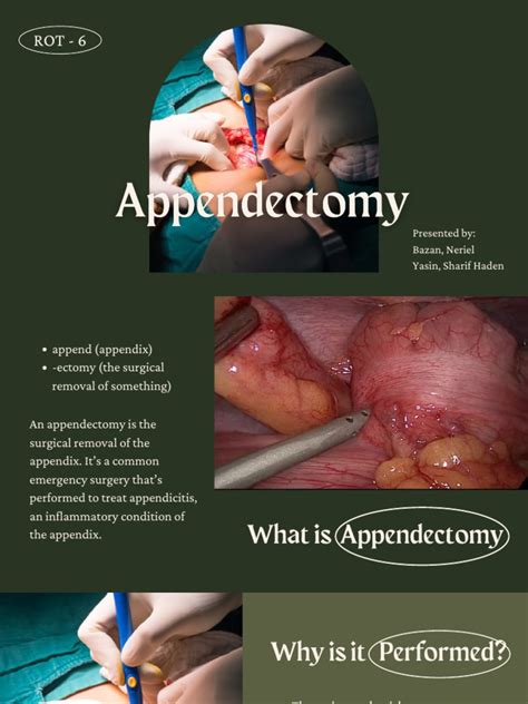 Appendectomy Pdf Surgery Surgical Suture