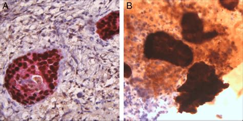 Pathology From Endoscopic Retrograde Cholangiopancreatography Biopsies Download Scientific