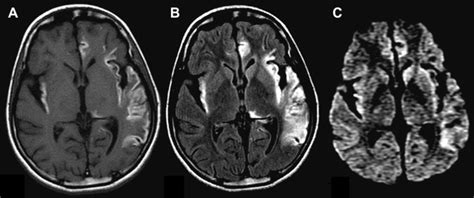 Diffusion Imaging In Brain Infections Radiology Key