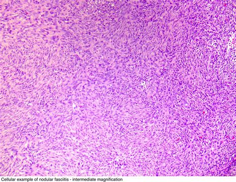 Pathology Outlines Nodular Fasciitis