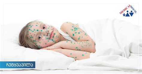 ჩუტყვავილა