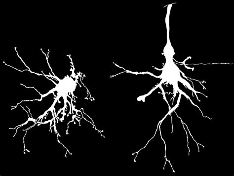 Fractal Dimension D Of The Neurons Of The Human Superior Temporal