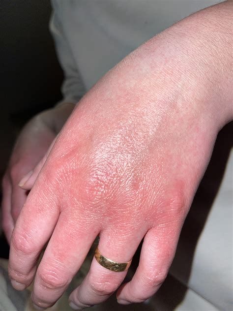 Hand Rash At Random Times Dry And Itchy R Dermatologyquestions