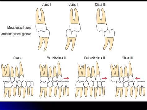 Classification Of Normal Occlusion And Malocclusion Ppt Dental