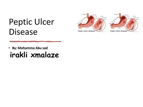 Peptic Ulcer Mohammad Abu Sad 1pptx