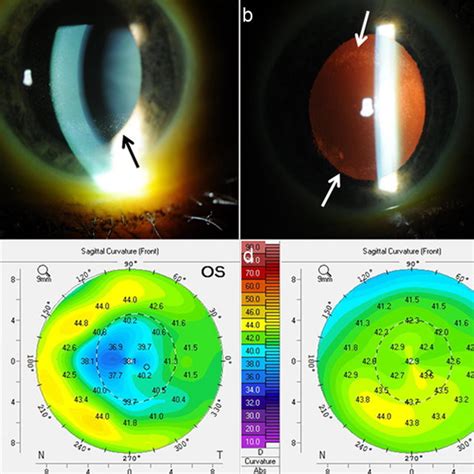 Outcomes Of Patients Experiencing Ocular Side Effects While On Systemic Download Scientific
