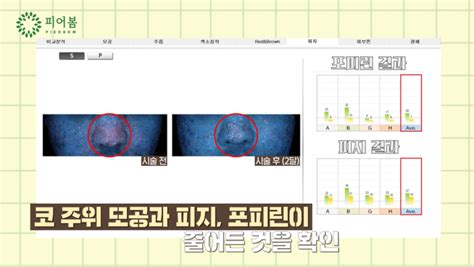 피부 정밀 진단기 마크뷰에 대하여 네이버 블로그
