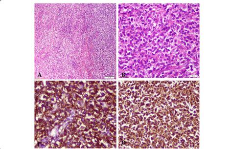 A Primary Adrenal Lymphoma Showing Infiltration Of The Adrenal Cortex