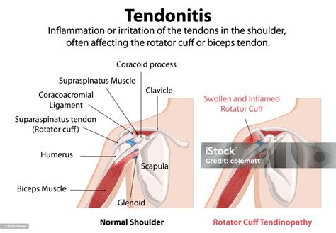 Inflammation Of Shoulder Tendons Rotator Cuff Stock Illustration