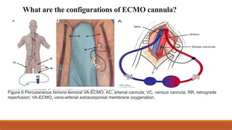 Extracorporeal Membrane Oxygenation Ecmo Pptx Lung And Respiratory Health Diseases And