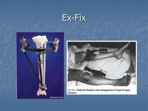Ppt Orthopedic Surgery Powerpoint Presentation Id1747320