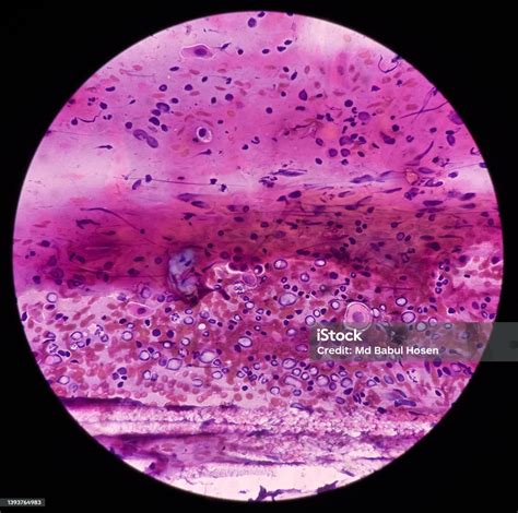 편평 상피 내 병변 아빠의 얼룩 심한 염증과 관련된 반응성 세포 변화 초점 보기 0명에 대한 스톡 사진 및 기타 이미지 Istock