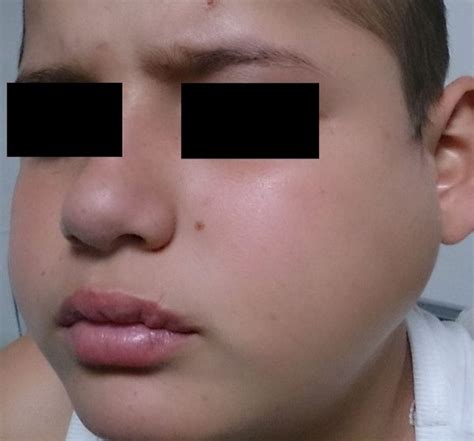 Mumps Cause Symptoms Signs Management Geeky Medics