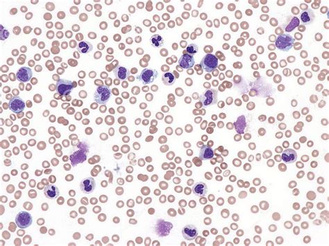 Chronic Myelomonocytic Leukemia Stock Image Image Of Cells