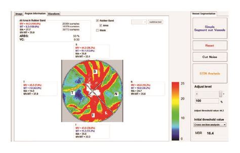 Analysis Of Circulation In The Optic Nerve Head By Laser Speckle