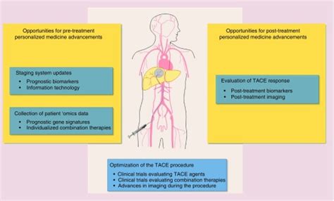 The Status Of Transarterial Chemoembolization Treatment In The Era Of Precision Oncology Pmc