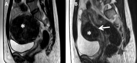Sagittal T2w Images Show A Intramural Uterine Fibroid White