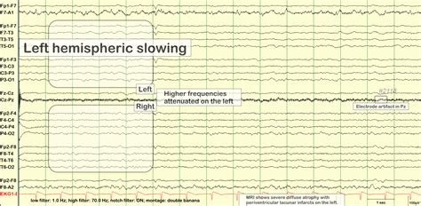 Focal Or Lateralized Slowing