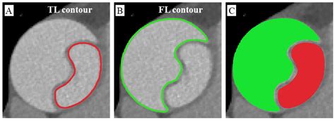 Diagnostics Free Full Text Automatic Segmentation Of Type A Aortic Dissection On Computed