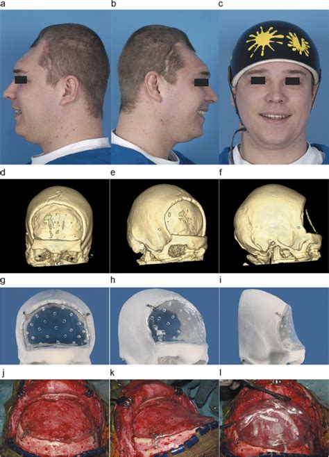 Two Stage Cranioplasty Tissue Expansion Directly Over The Craniectomy Defect Prior To