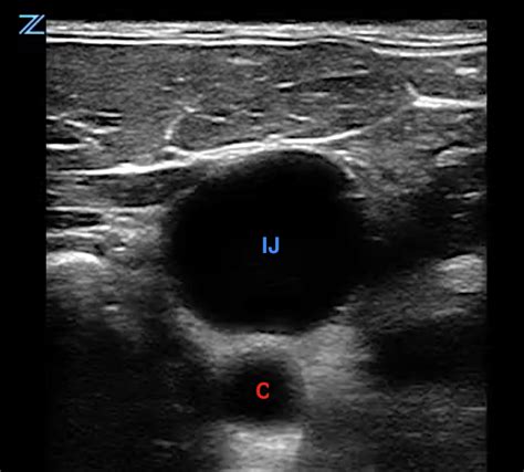 Ultrasound Guided Peripheral Access Part 2 Emergency Physicians Monthly