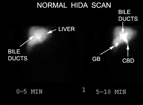 Functional Testing For Gallbladder Health