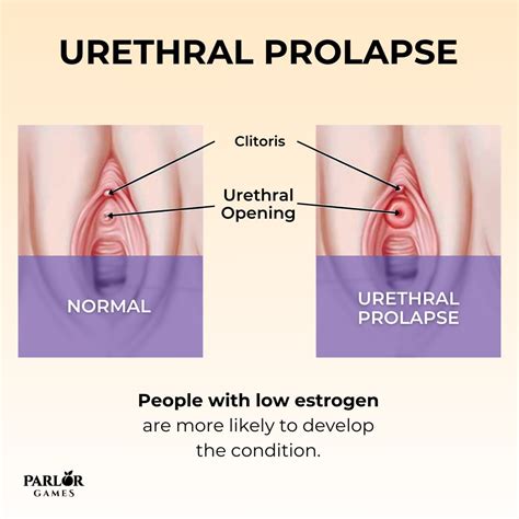 Vaginal Prolapse Diagram Vaginal Repair Dr Marcus Carey