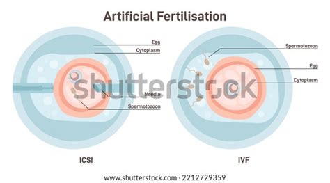Artificial Fertilization Types Female Egg Insemination Stock Vector