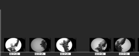 An Automatic Grouping Algorithm Uses The Intervals Of The X Rays