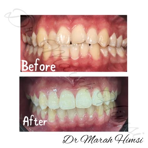 Marah Himsi On Linkedin Patient Complained From Class 3 Occlusion And