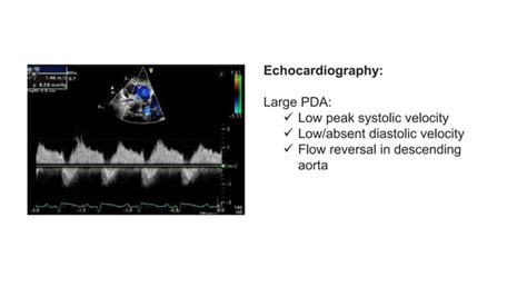 Patent Ductus Arteriosus Pda Echocardiographic Assessment Anatomy Flow And Suitability For Closure