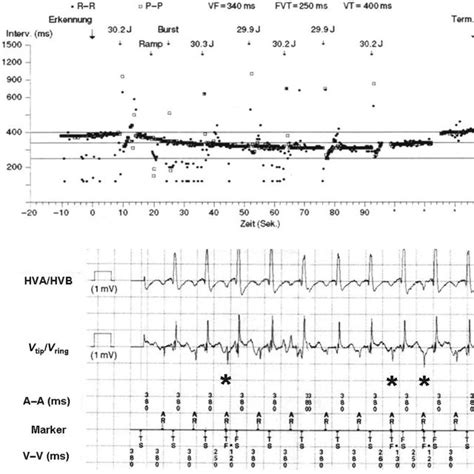 Changes In Sensed R Wave Amplitude And Morphology Leading To Far Field Download Scientific