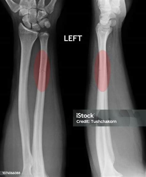 골절의 반경 및 척 골 뼈 X 선 필름 샤프트 건강관리와 의술에 대한 스톡 사진 및 기타 이미지 건강관리와 의술 골절 과학 Istock