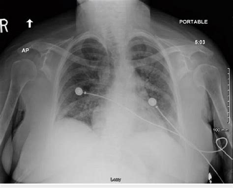 Chest X Ray Of The Patient Showing Diffuse And Bilateral Interstitial Download Scientific