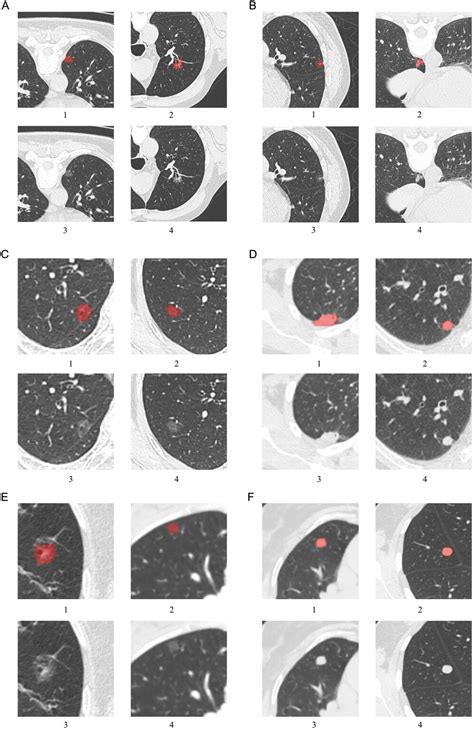 Classification of Pulmonary Nodules Using Multimodal Feature‐Driven Graph Convolutional Networks ...